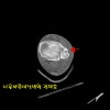 복숭아뼈 골절 발목 골절 개방적 정복술 및 금속판 고정하는 방법 서울바른세상병원 권제호 네이버 블로그